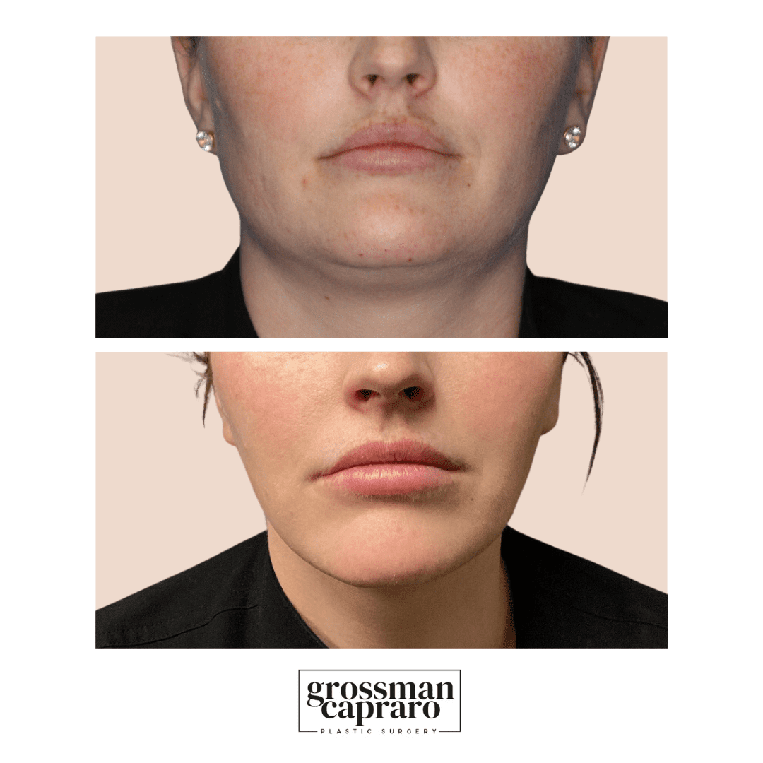 Patient Diary: What’s It Like To Have Submental Liposuction?