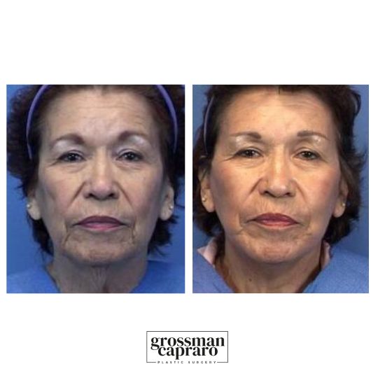 Face Lift | Grossman Capraro Plastic Surgery