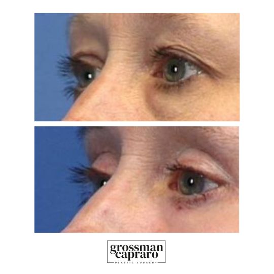 Eyelid Lift | Grossman Capraro Plastic Surgery