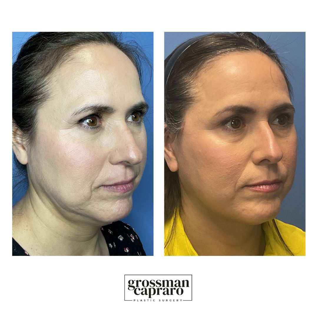 Face Lift | Grossman Capraro Plastic Surgery