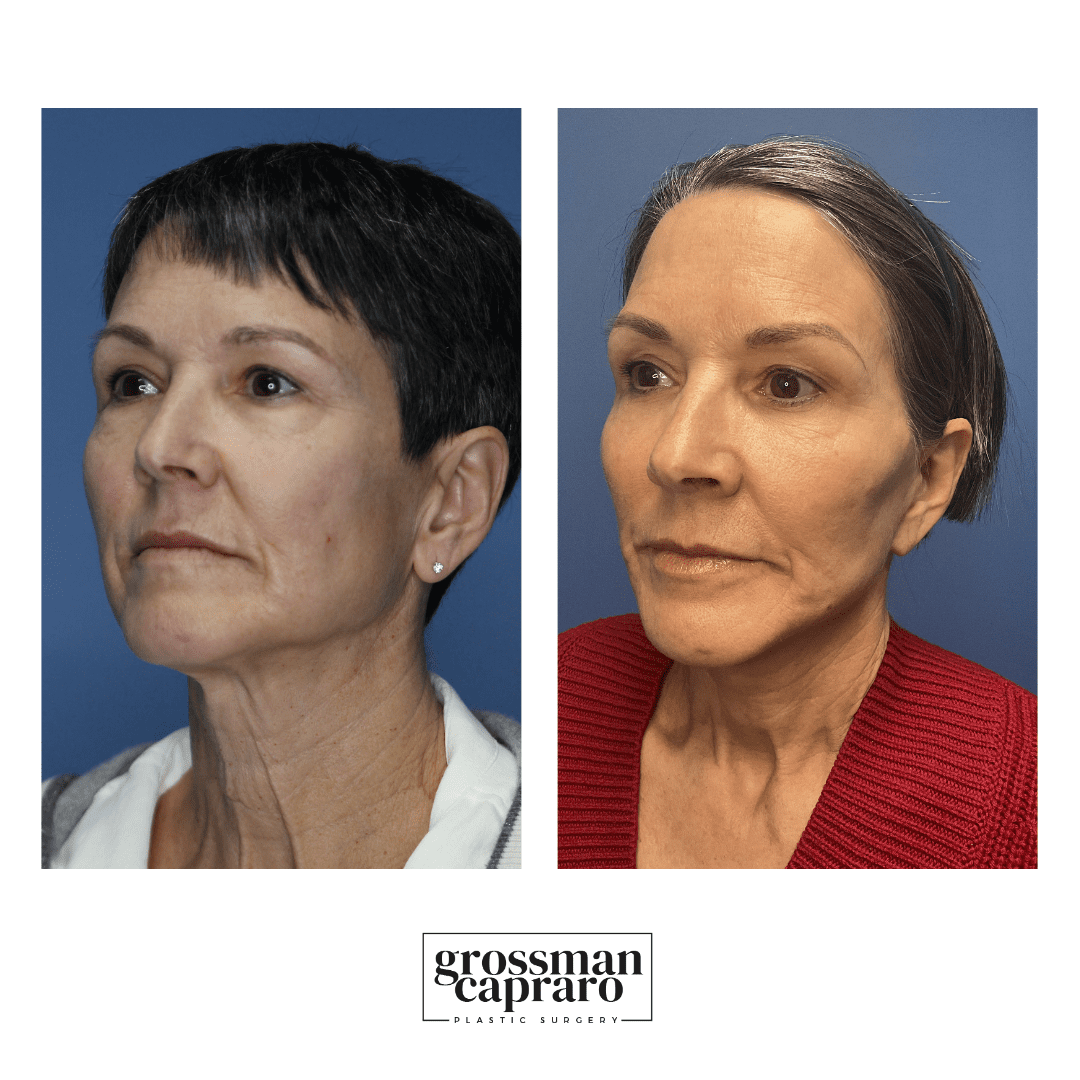 Face Lift | Grossman Capraro Plastic Surgery