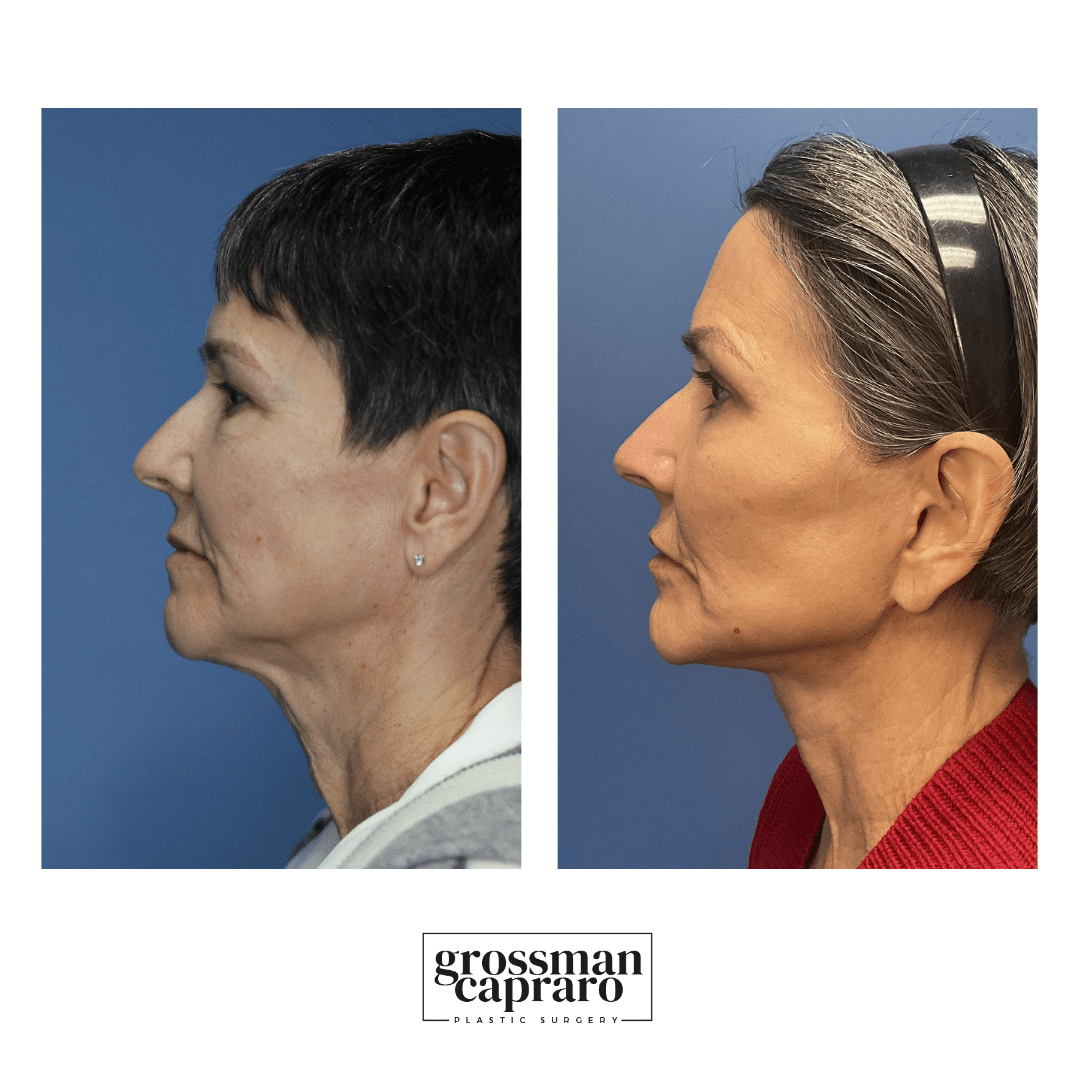 Face Lift | Grossman Capraro Plastic Surgery