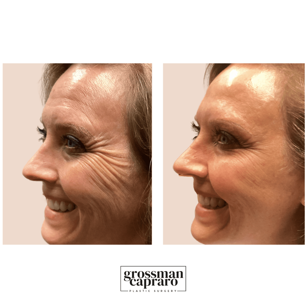 Gallery Of Botox Denver| Greenwood Village | Beverly Hills CA