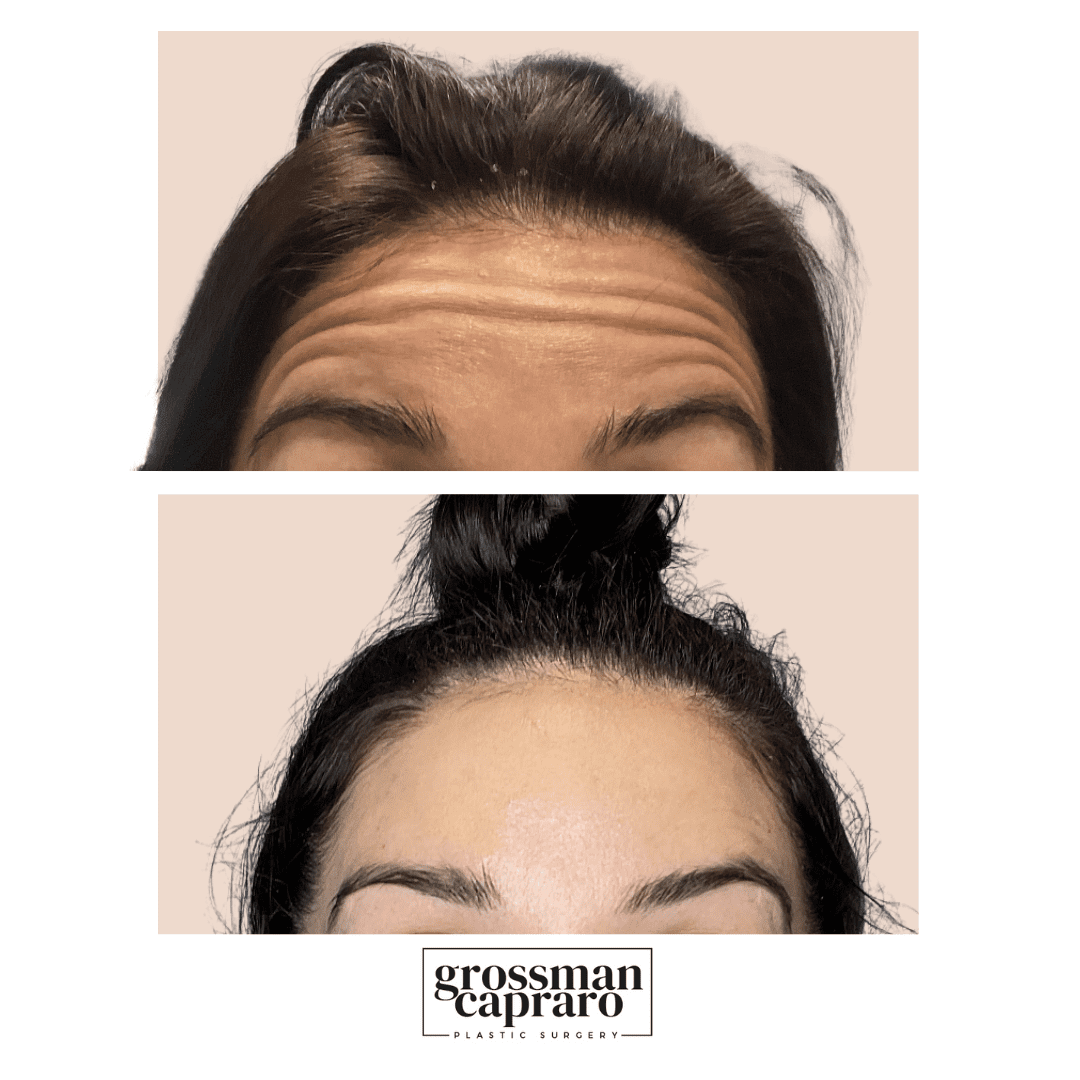 Gallery Of Botox Denver| Greenwood Village | Beverly Hills CA